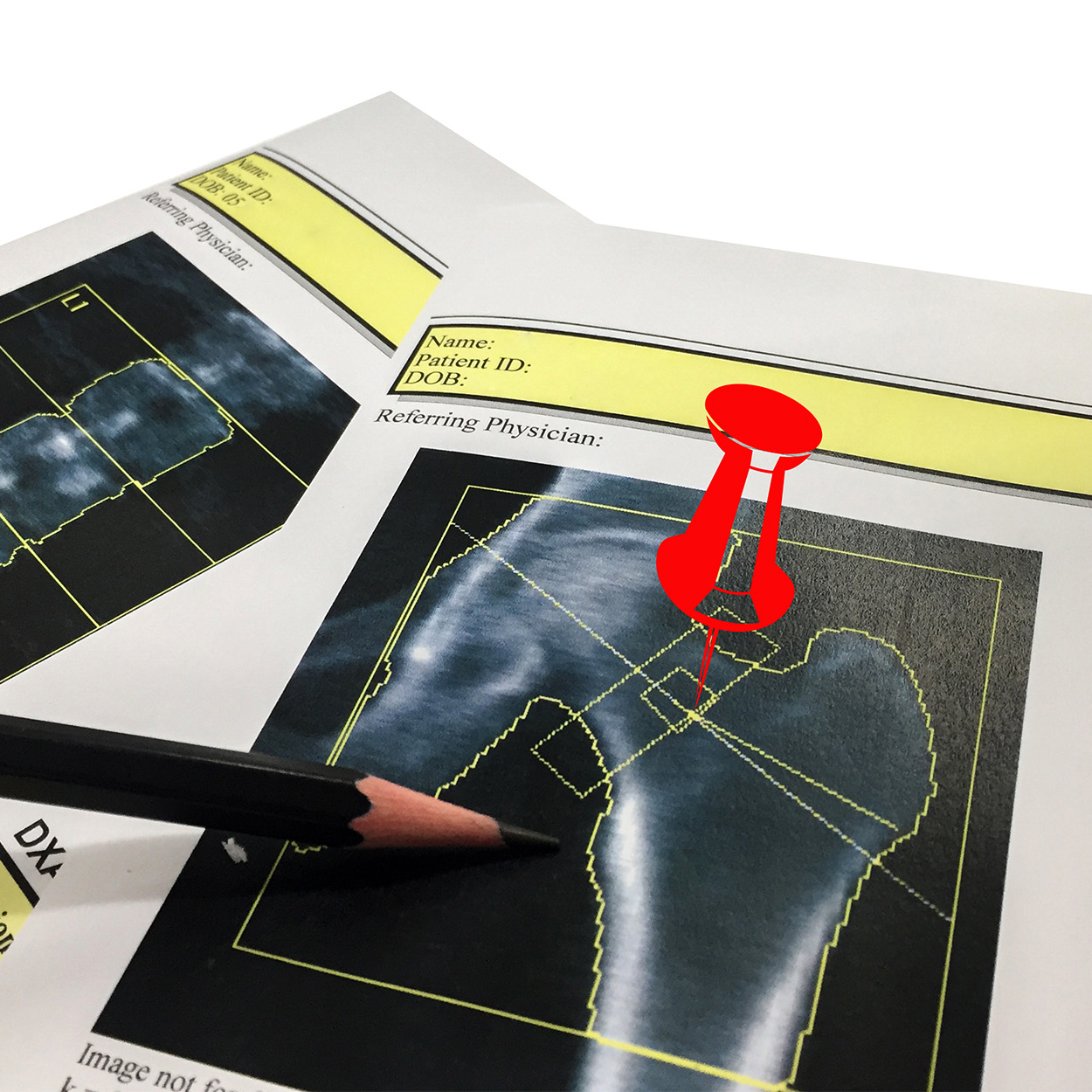 Advancements in DEXA Scan Images for Bone Density